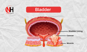 Bladder Cancer - Nazeer Hospital