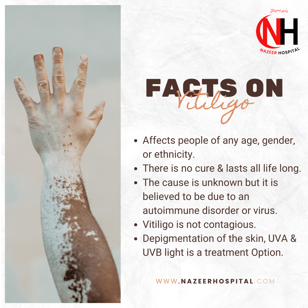 World Vitiligo Day: Causes and Symptoms - Nazeer Hospital