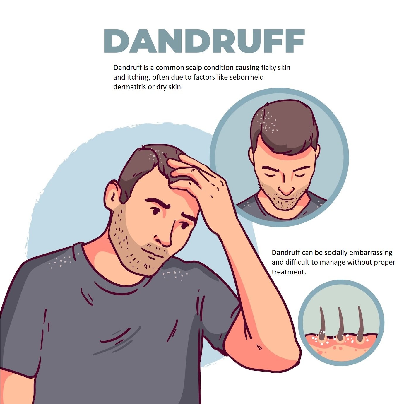 Understanding Dandruff and Effective Treatments.